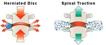 Y-Strap Decompression Irvine & OC | Dr Tyler Bigenho | CleanSpine